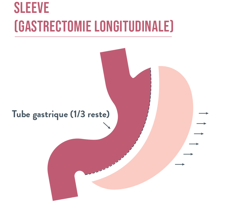 La chirurgie bariatrique - Bariatric Advantage Europe La chirurgie bariatrique - Bariatric Advantage Europe